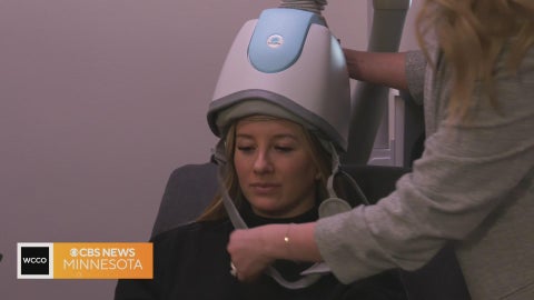 What is transcranial magnetic stimulation? - CBS Minnesota