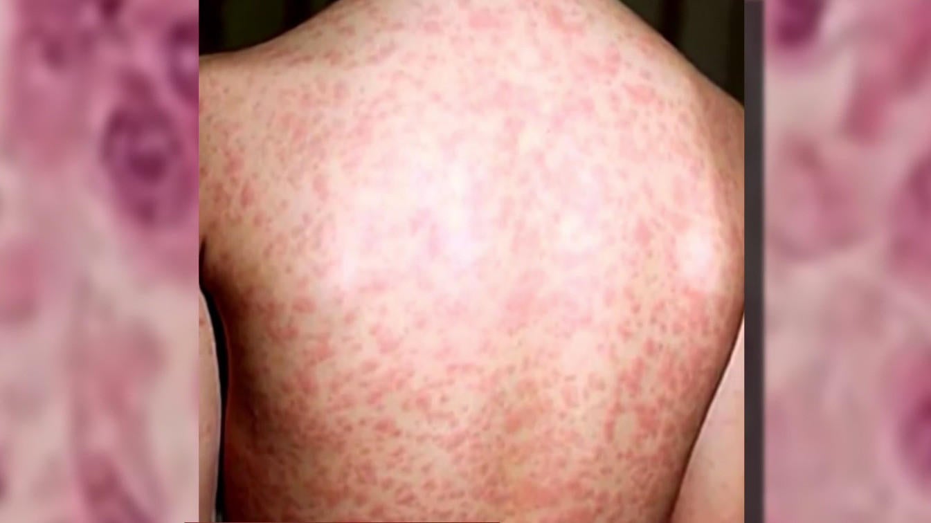 Case of measles confirmed in Northwest Indiana, first since 2019 - CBS ...