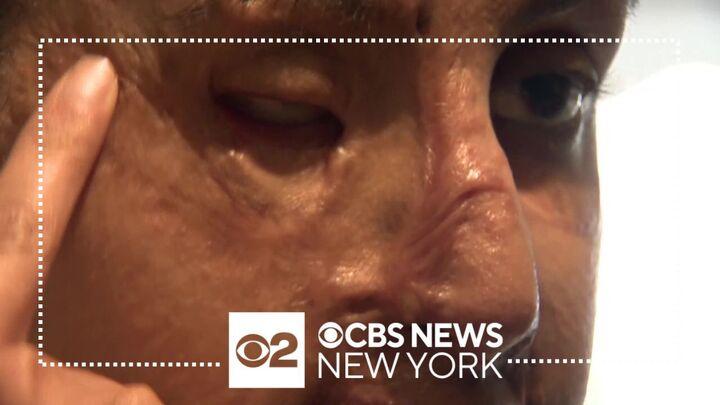 Long Island's Nafiah Ikram continues to heal, 3 years after brutal acid ...