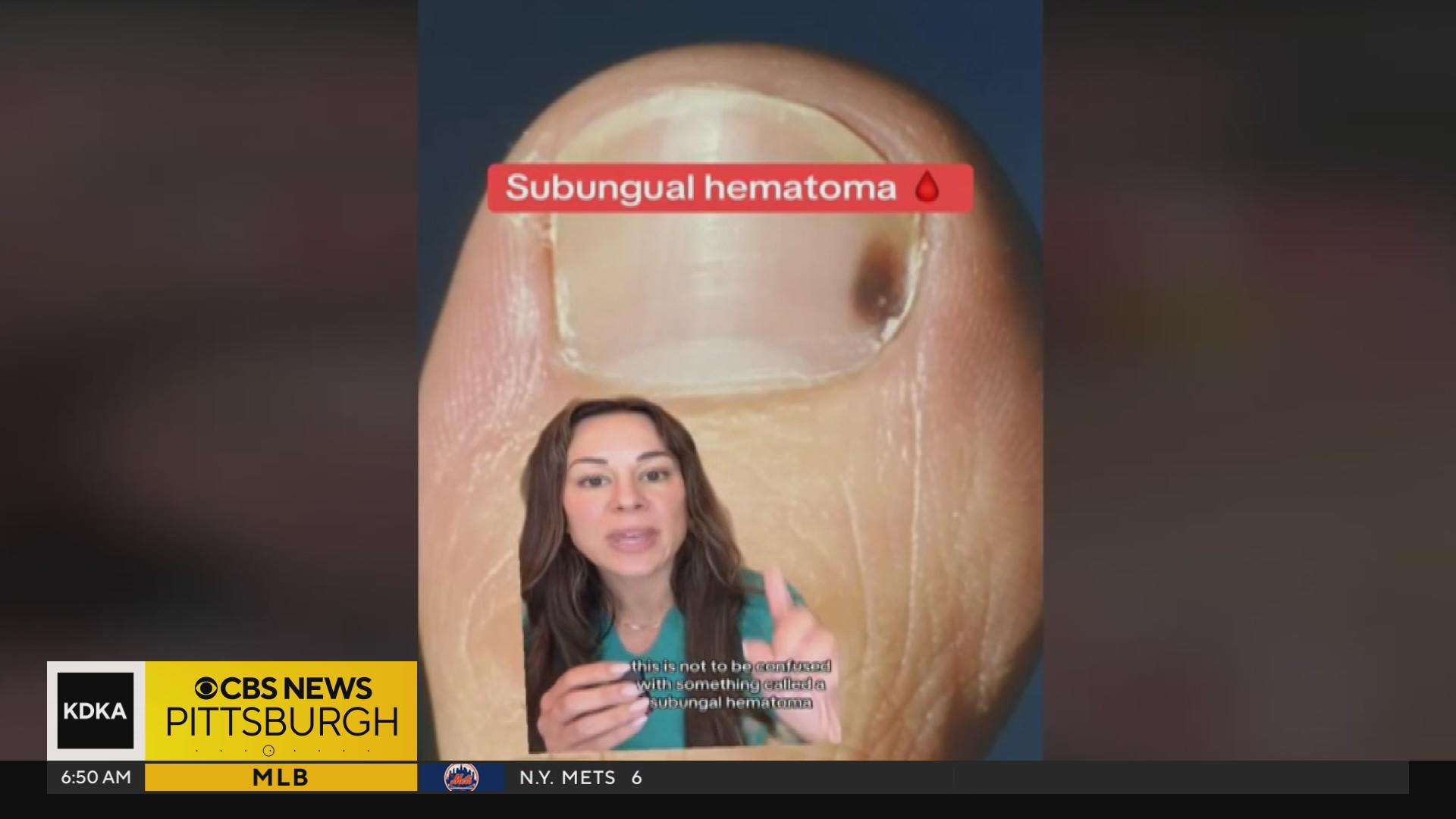 Nail-ing a potential cancer risk that exists just beneath the surface ...