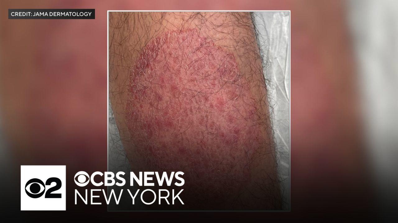 New sexually transmitted form of ringworm reported in New York City ...