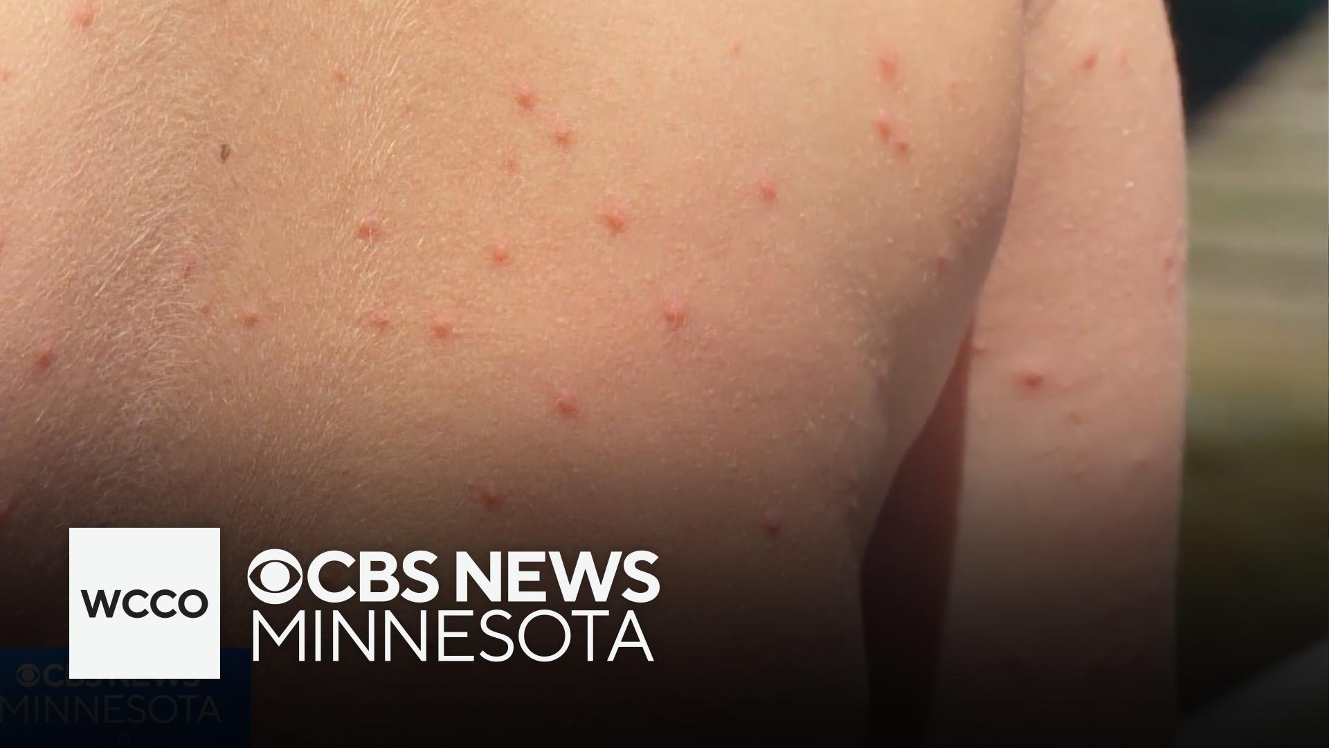 What is swimmer's itch and how do you treat it? - CBS Minnesota