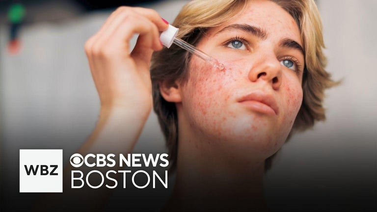 What is cortisol? How to lower levels amid concerns over "cortisol face ...