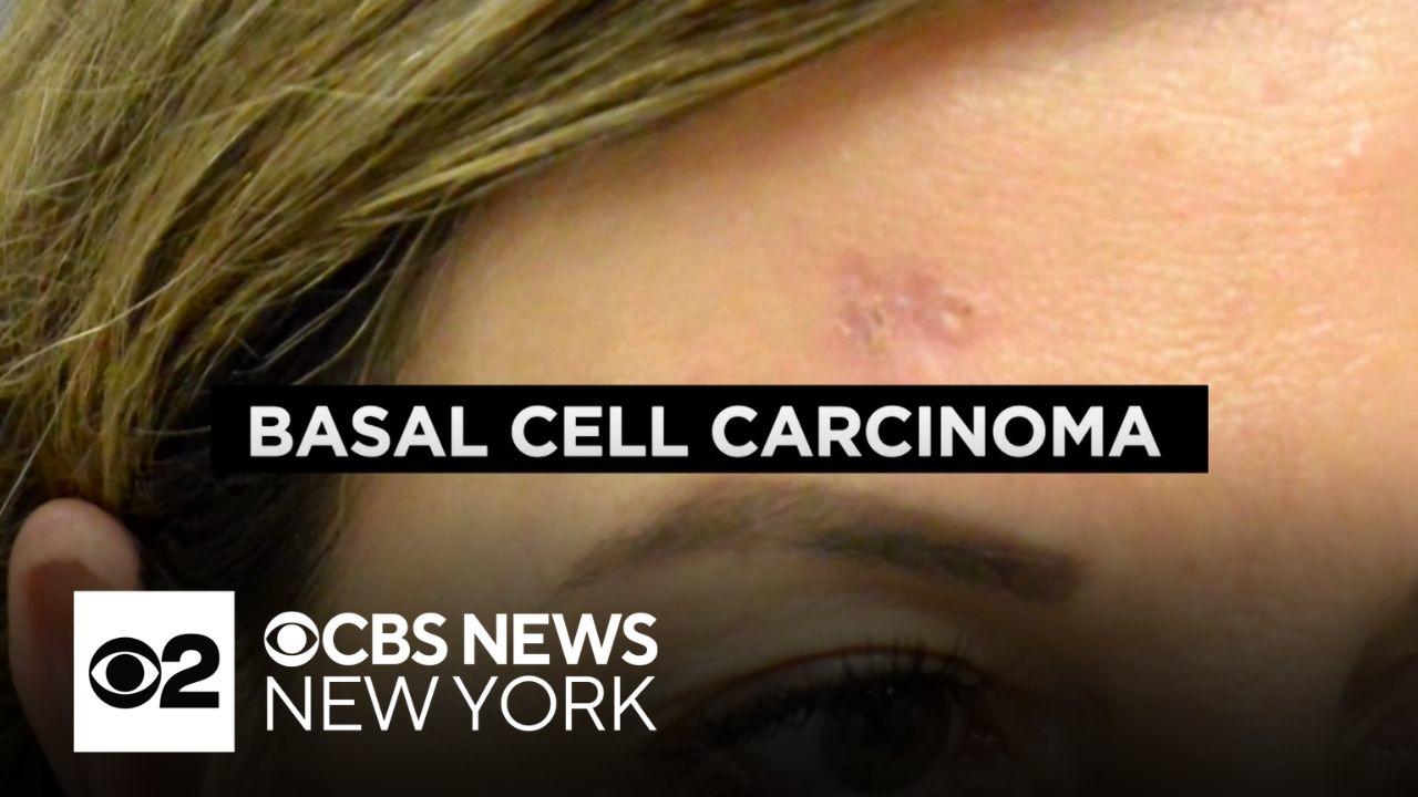 Gov. Kathy Hochul has basal cell carcinoma removed from nose. What to ...