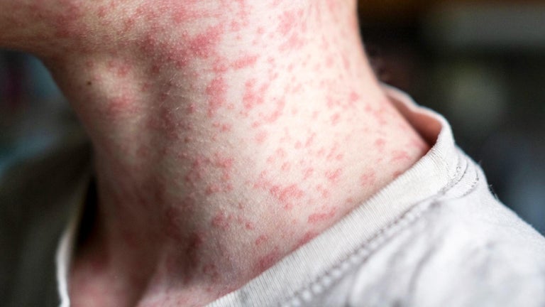 New Mexico resident tests positive for measles after dying, cause of ...