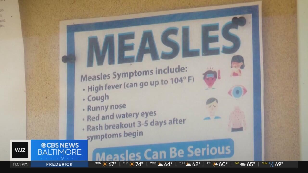 Maryland resident confirmed to have measles after international travel - CBS Baltimore