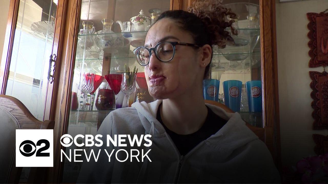 Long Island acid attack survivor Nafiah Ikram says "every day is a ...