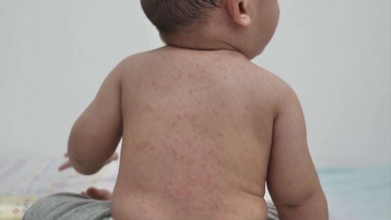 As Colorado measles cases grow, doctors share who does, and doesn't ...