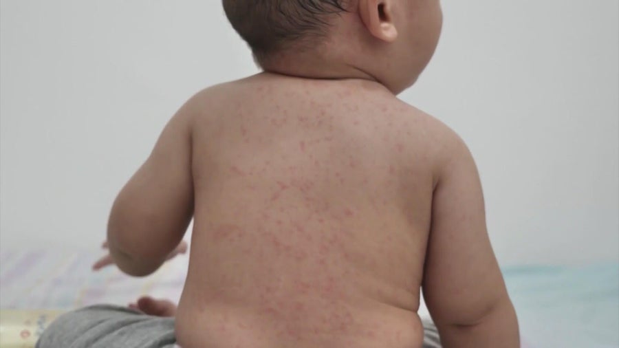 As Colorado measles cases grow, doctors share who does, and doesn't ...