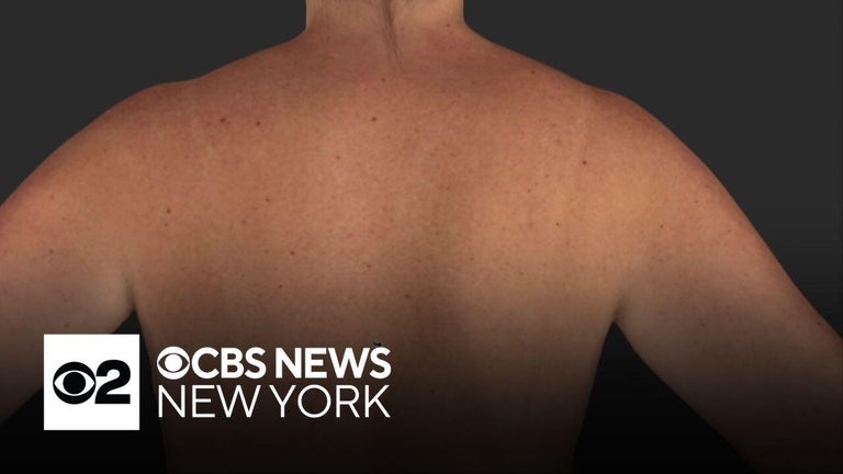 Detecting, monitoring skin cancers made easier with new screening ...
