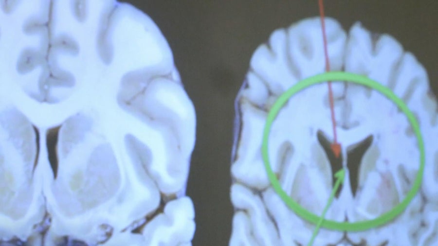 What is CTE, the brain condition referenced by Midtown Manhattan ...