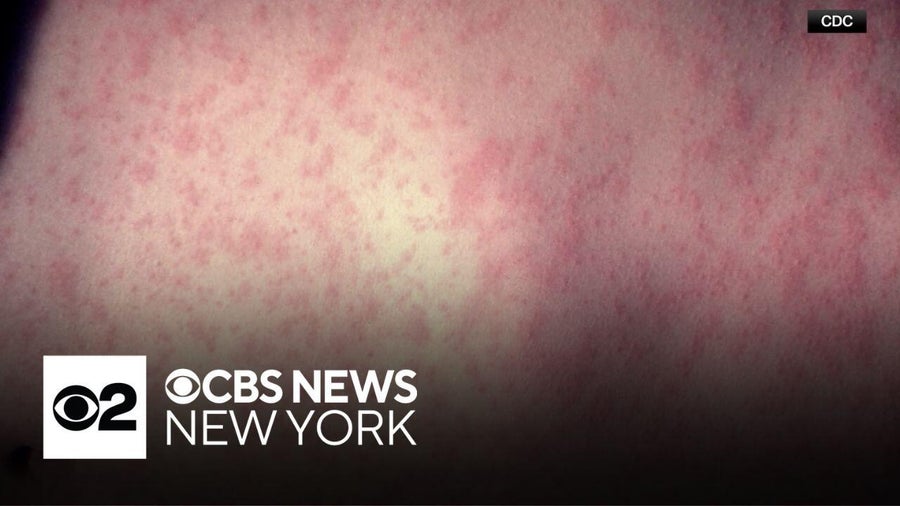 Measles case confirmed in Passaic County, New Jersey, health officials ...