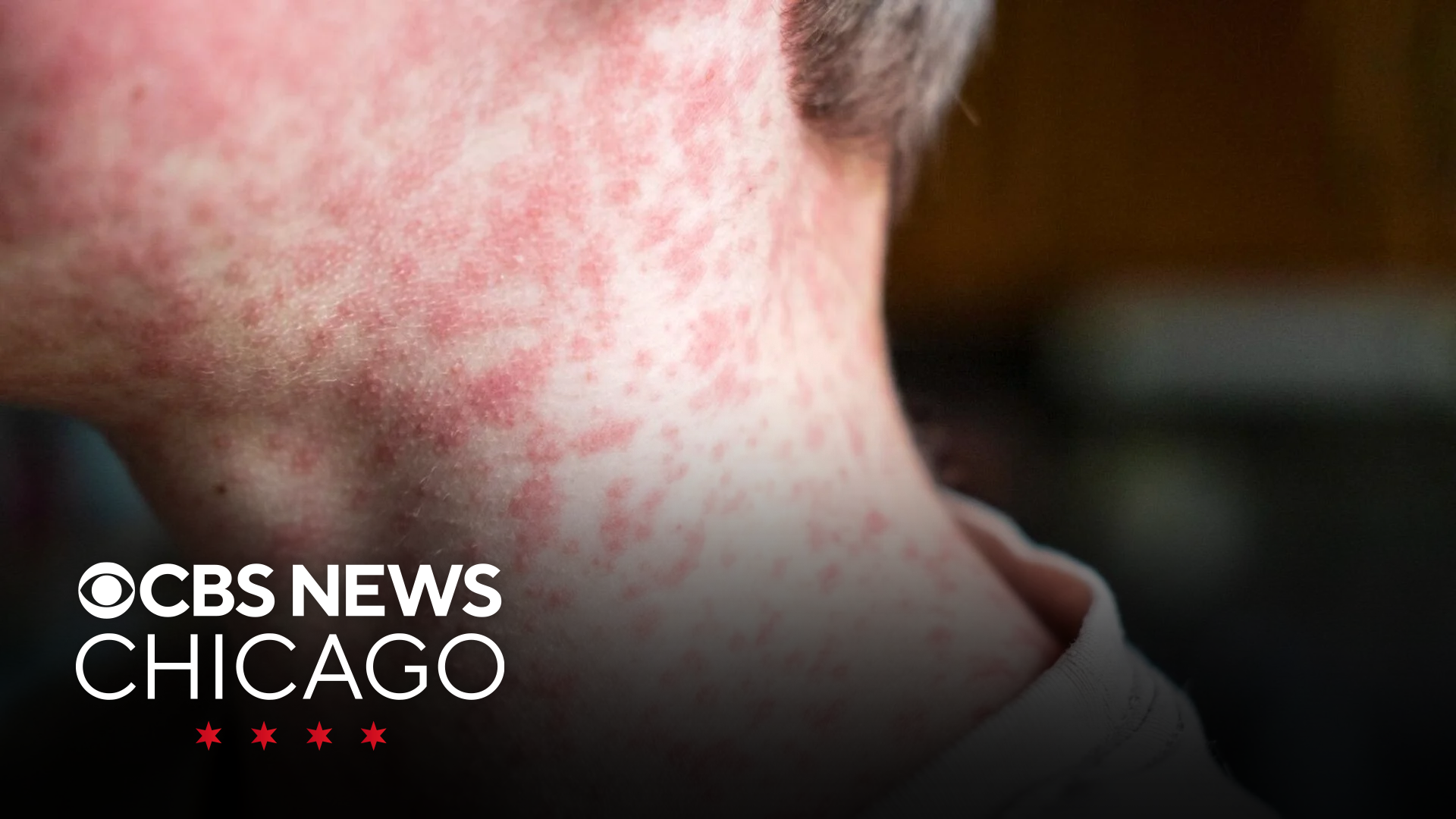 Second case of measles for 2025 confirmed in suburban Cook County ...