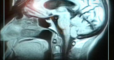 FDA Approves New Alzheimer's Drug - CBS News