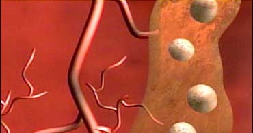 Breakthrough For Cancer Survivors - CBS News