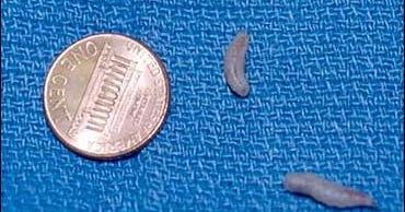 Got Leg Ulcers? Try Maggots - CBS News