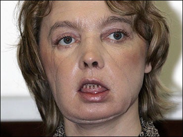 Amazing face transplants (GRAPHIC IMAGES)