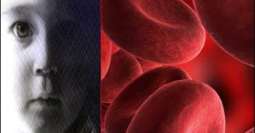 Childhood Leukemia Increases Cancer Risk - CBS News