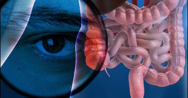 Flat Colon Growths A Likely Cancer Cause - CBS News