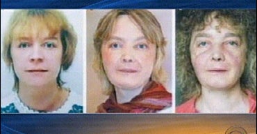 Face Transplant Recipient "Perfect" - CBS News