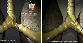 Stem Cell-Grown Windpipe Transplant Works - CBS News