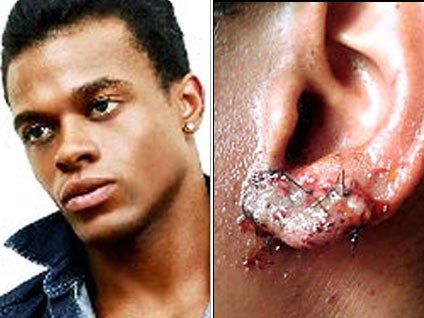 Man Bites Ear: You Have to Hear It to Believe It - CBS News