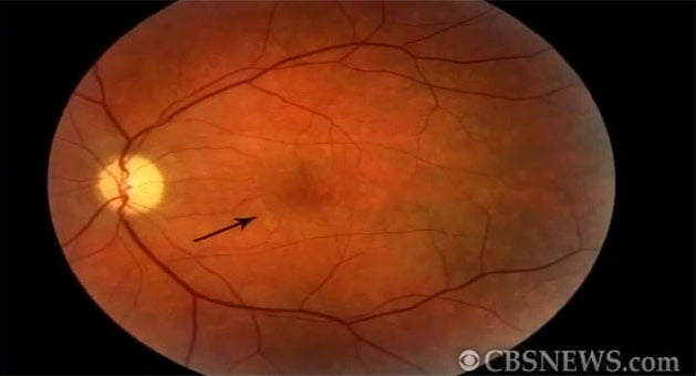 Lasers Blast Worm That Was Eating Man's Eye (PICTURE/VIDEO) - CBS News