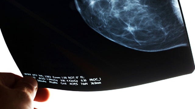 Do mammograms really save lives? New study adds to debate - CBS News
