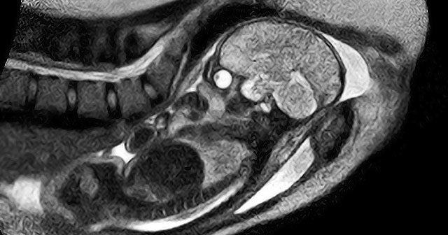 Moment of Birth Captured on MRI