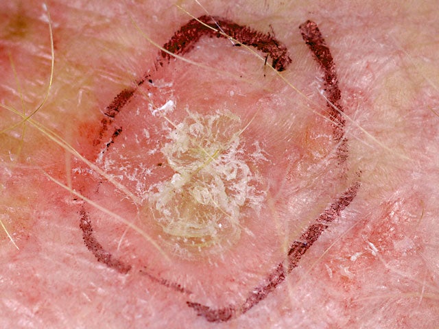 Is it skin cancer?