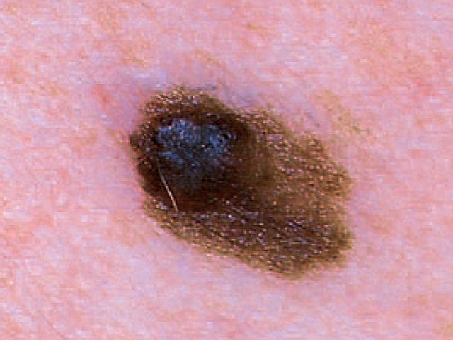 Is it skin cancer?