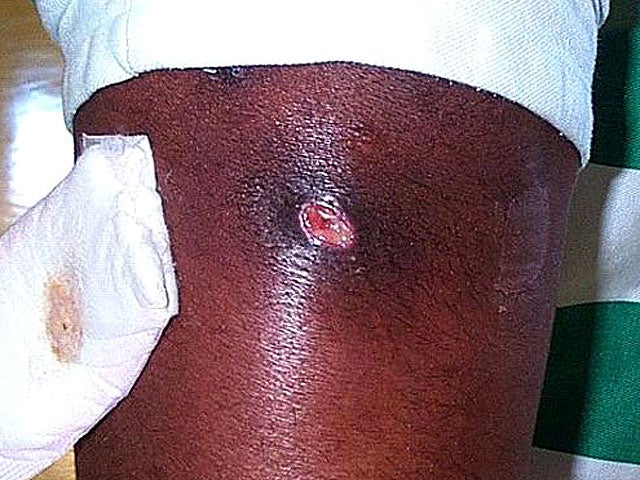 Deadly skin infection? 12 graphic photos that could save your life