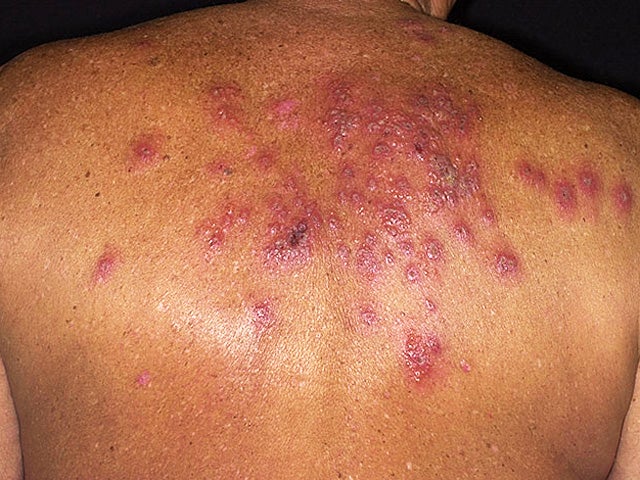 Is it shingles? 7 myths about painful illness (graphic images)