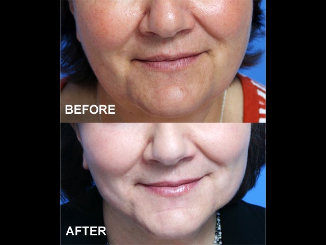 13 bizarre but popular plastic surgery procedures