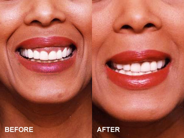 13 bizarre but popular plastic surgery procedures