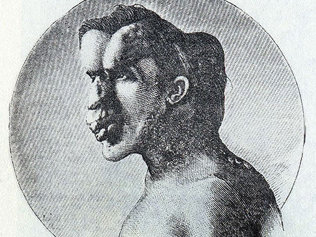 Proteus syndrome: The Elephant Man and beyond