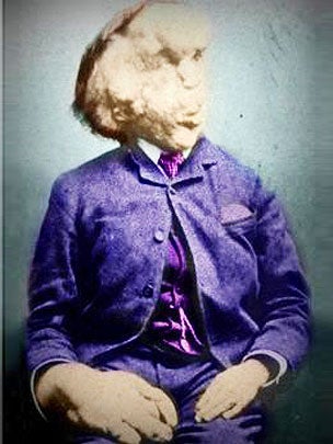 Proteus syndrome: The Elephant Man and beyond