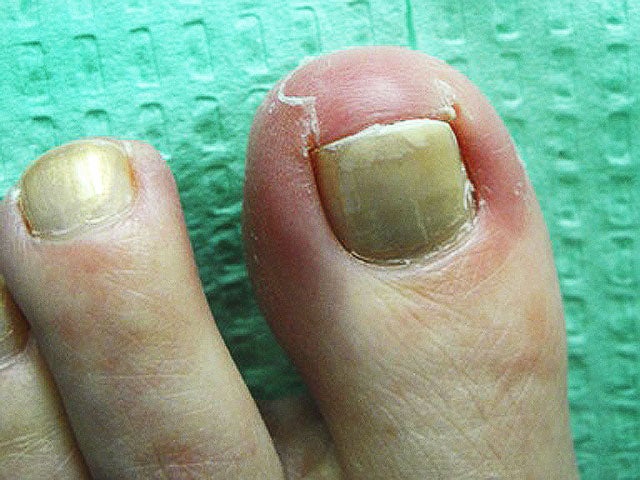 Ouch! 7 nasty foot flaws and how to fix them (GRAPHIC IMAGES)