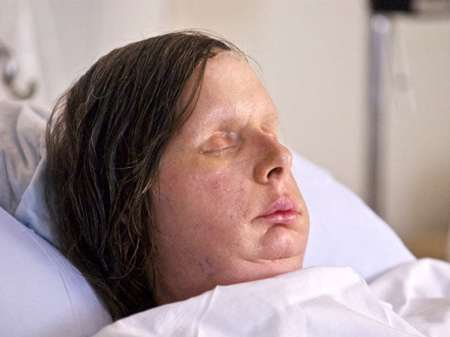 Amazing face transplants (GRAPHIC IMAGES)