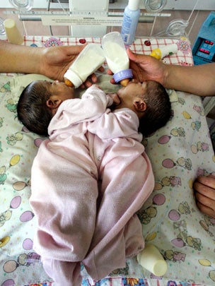 Conjoined twins (WARNING: GRAPHIC IMAGES)