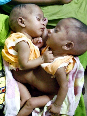 Conjoined twins (WARNING: GRAPHIC IMAGES)