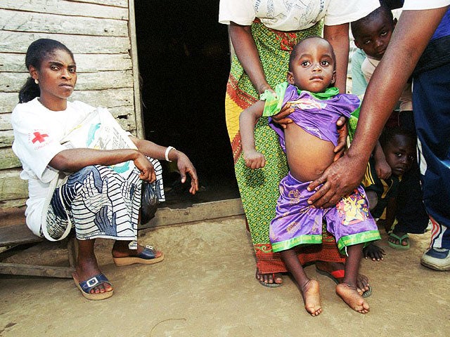 Poliomyelitis: 24 photos of crippling disease