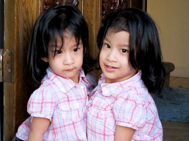 Conjoined twins (WARNING: GRAPHIC IMAGES)