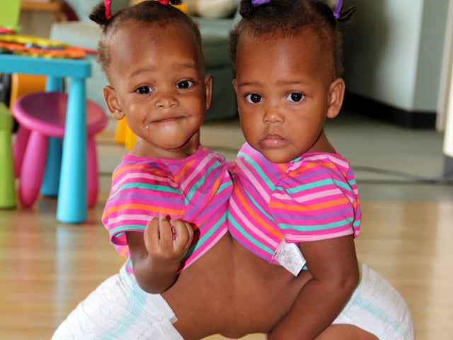 Conjoined twins Maria and Teresa Tapia said faring well - CBS News