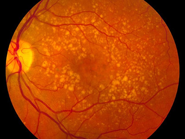 FDA Approves Regeneron Drug For Macular Degeneration CBS News fda-approves-regeneron-drug-for-macular-degeneration-cbs-news