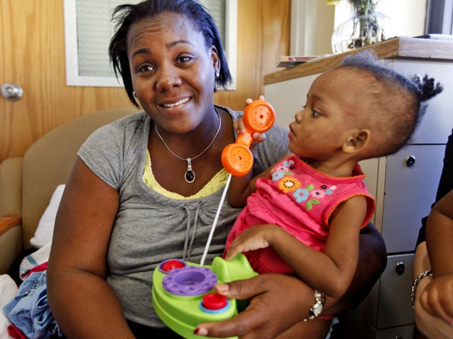 Conjoined twins Maria & Teresa Tapia: Before and after