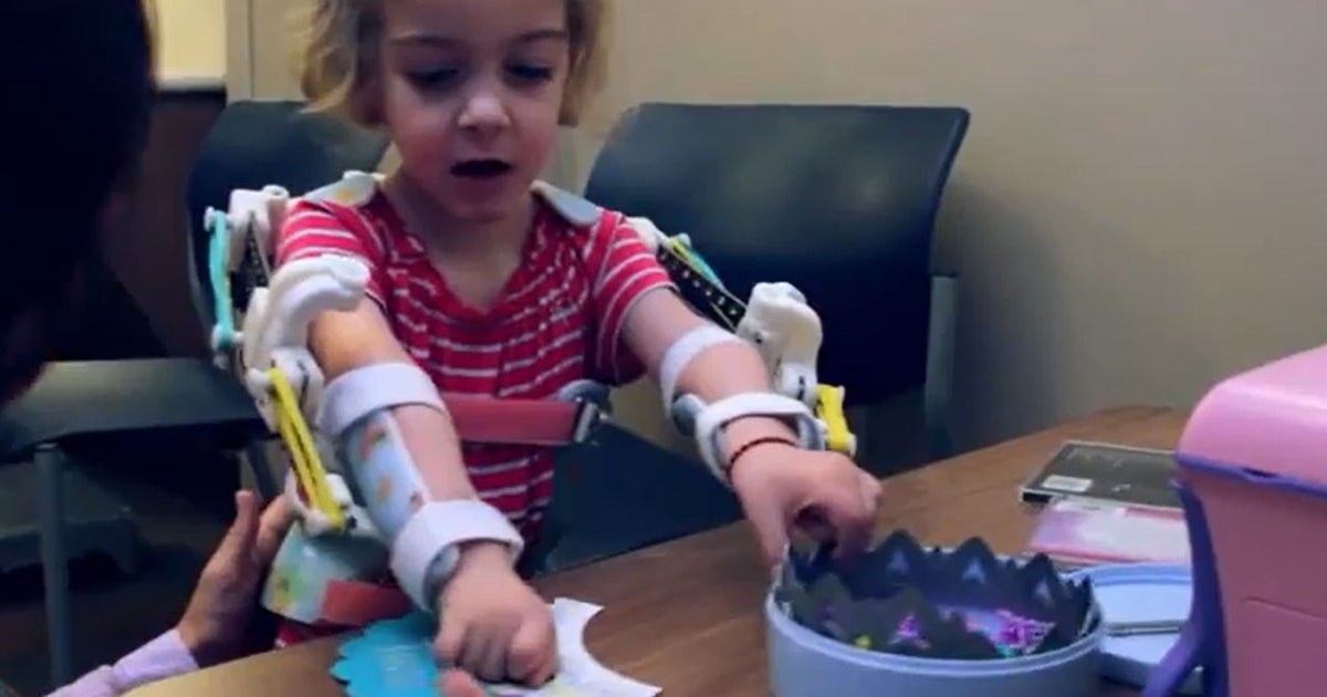 3D printer helps 4-year-old girl who can't use her arms play with toys ...