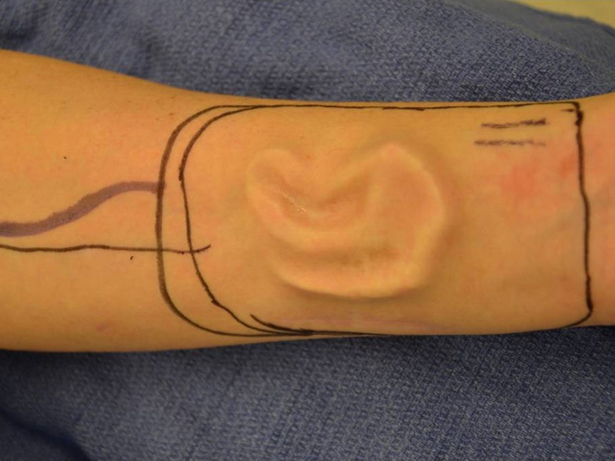 Ear reconstruction surgery (Graphic Photos)