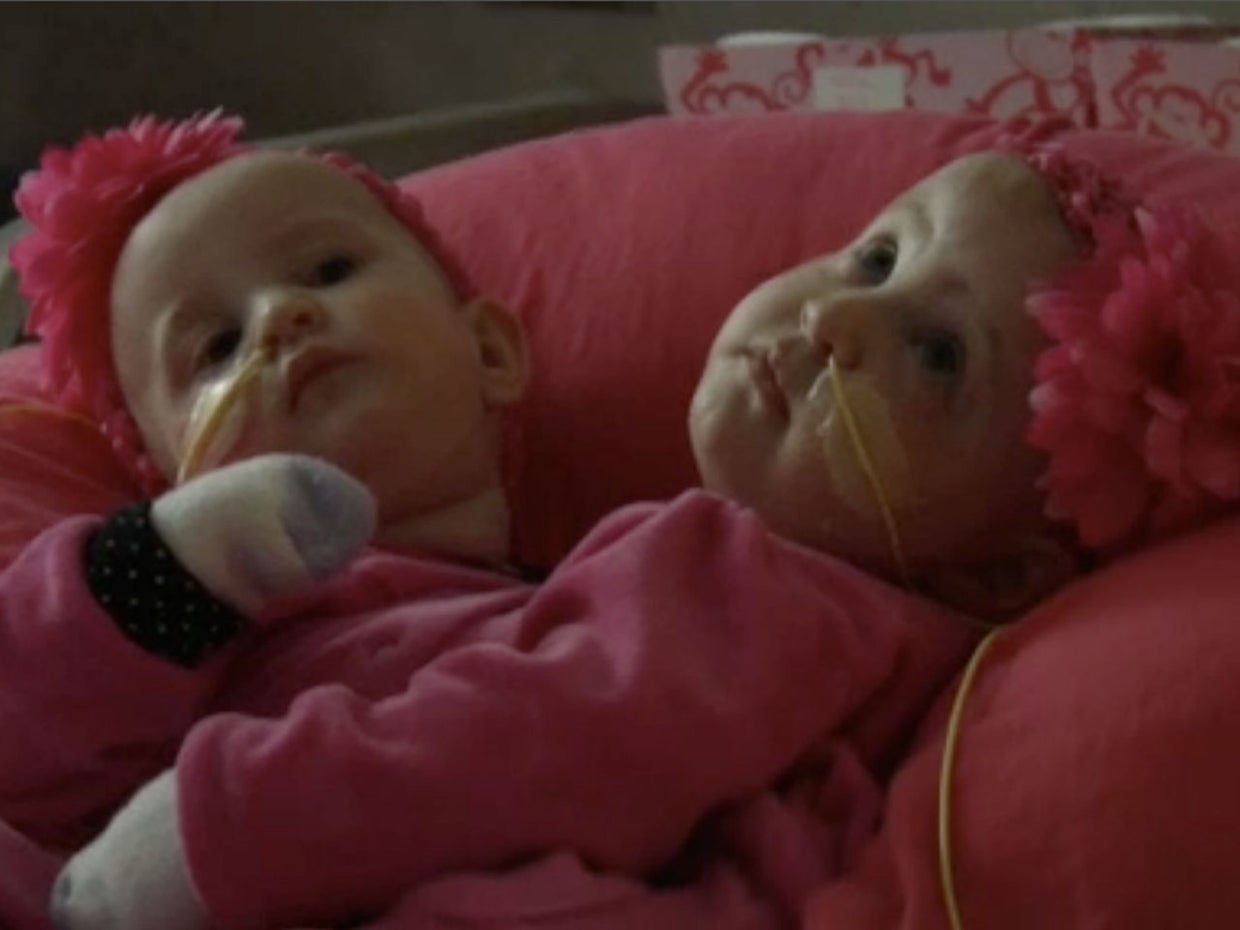 Conjoined twins: Allison and Amelia