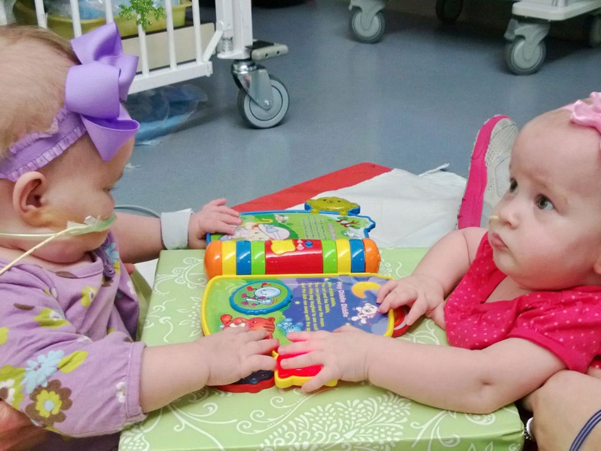 Conjoined twins: Allison and Amelia